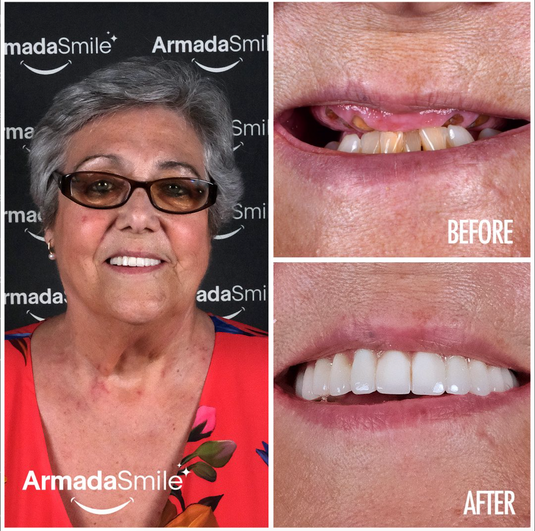ALL ON 6™ DENTAL IMPLANTS – Armada Smile